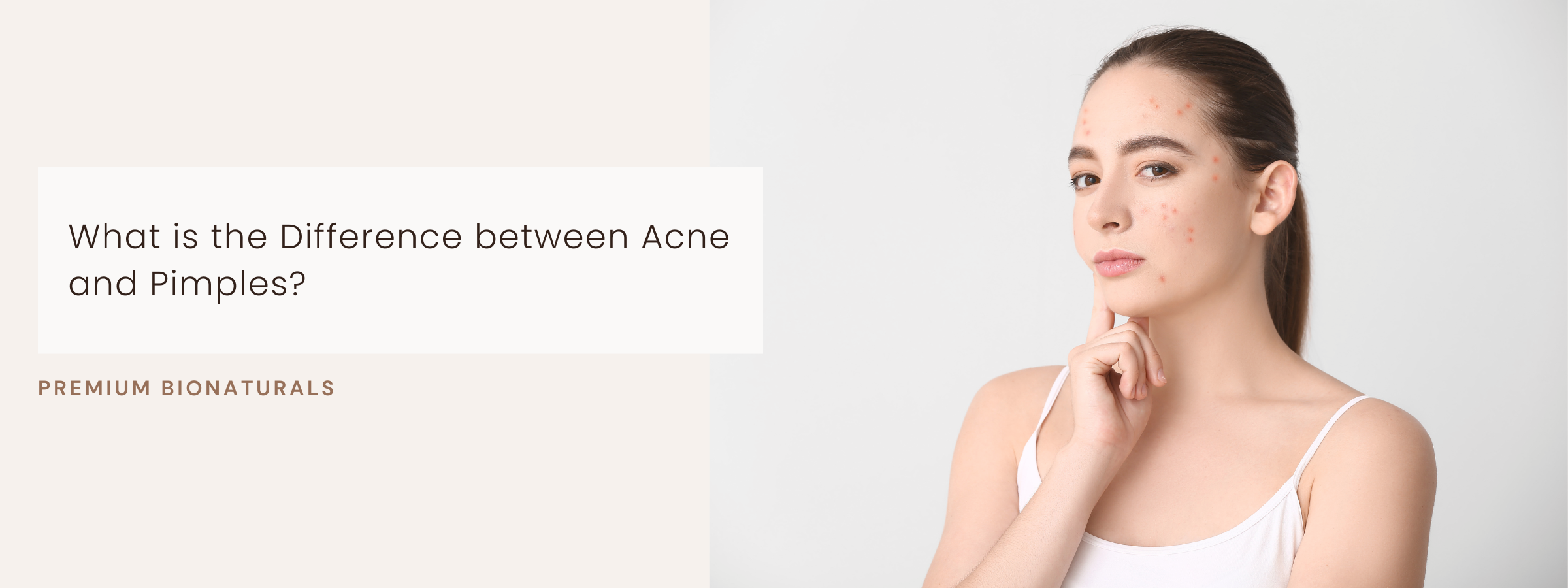 What is the Difference between Acne and Pimples? – Premium Bionaturals